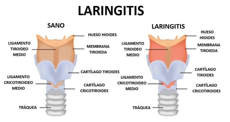 ¿Qué es la LARINGITIS? 🥇 | SÍNTOMAS y TRATAMIENTO