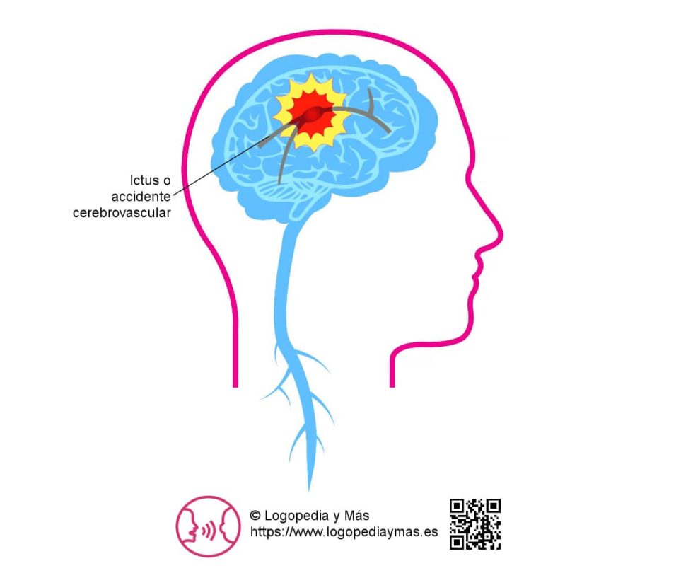 ¿Qué es un ICTUS? 🥇 | SÍNTOMAS, SECUELAS y TRATAMIENTO