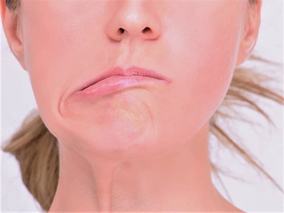 Tratamiento de la parálisis facial. Síntomas y causas - Logopedia y Más