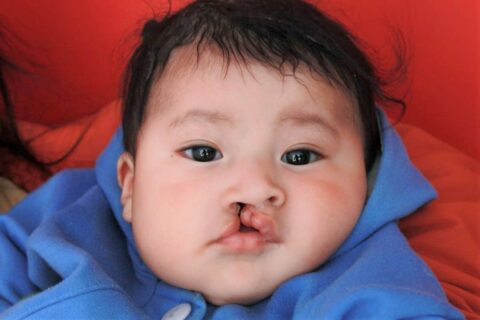 Qué es el LABIO LEPORINO. Causas y factores.