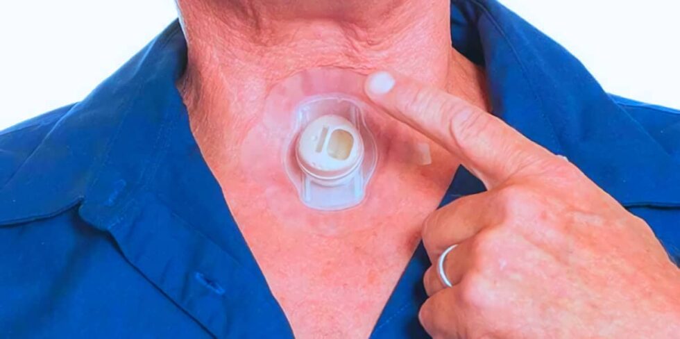 Prepararse para Laringectomía. Recuperación y Tratamiento.