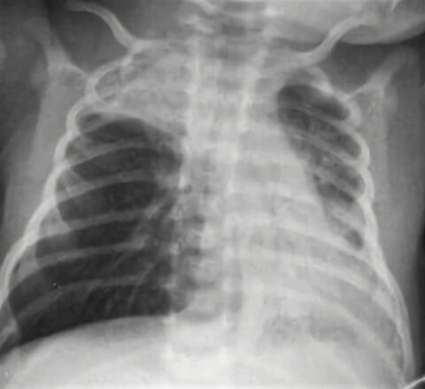 Bronquiolitis: cómo prevenir esta enfermedad - Logopedia y Más