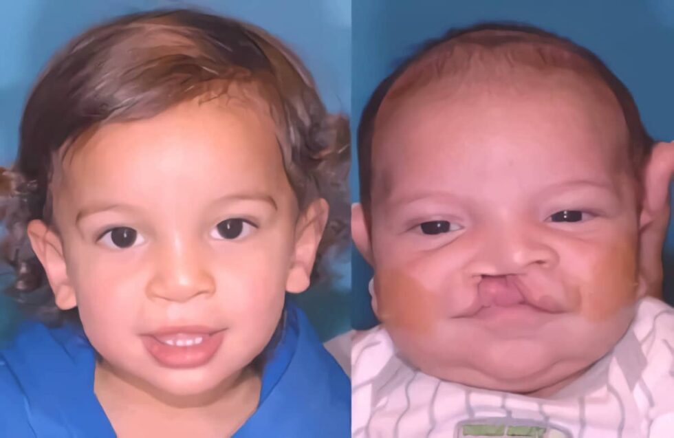 FISURA LABIO PALATINA 🥇 | Logopedia y Más